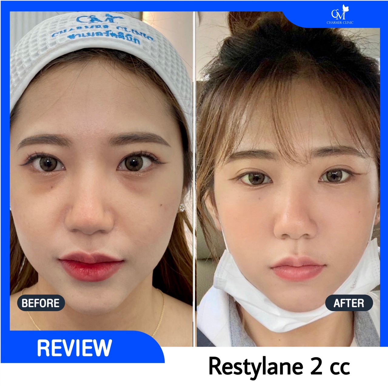 ฉีดฟิลเลอร์ Restylane Filler เติมเต็มปัญหาใต้ตา ร่องใต้ตาลึก