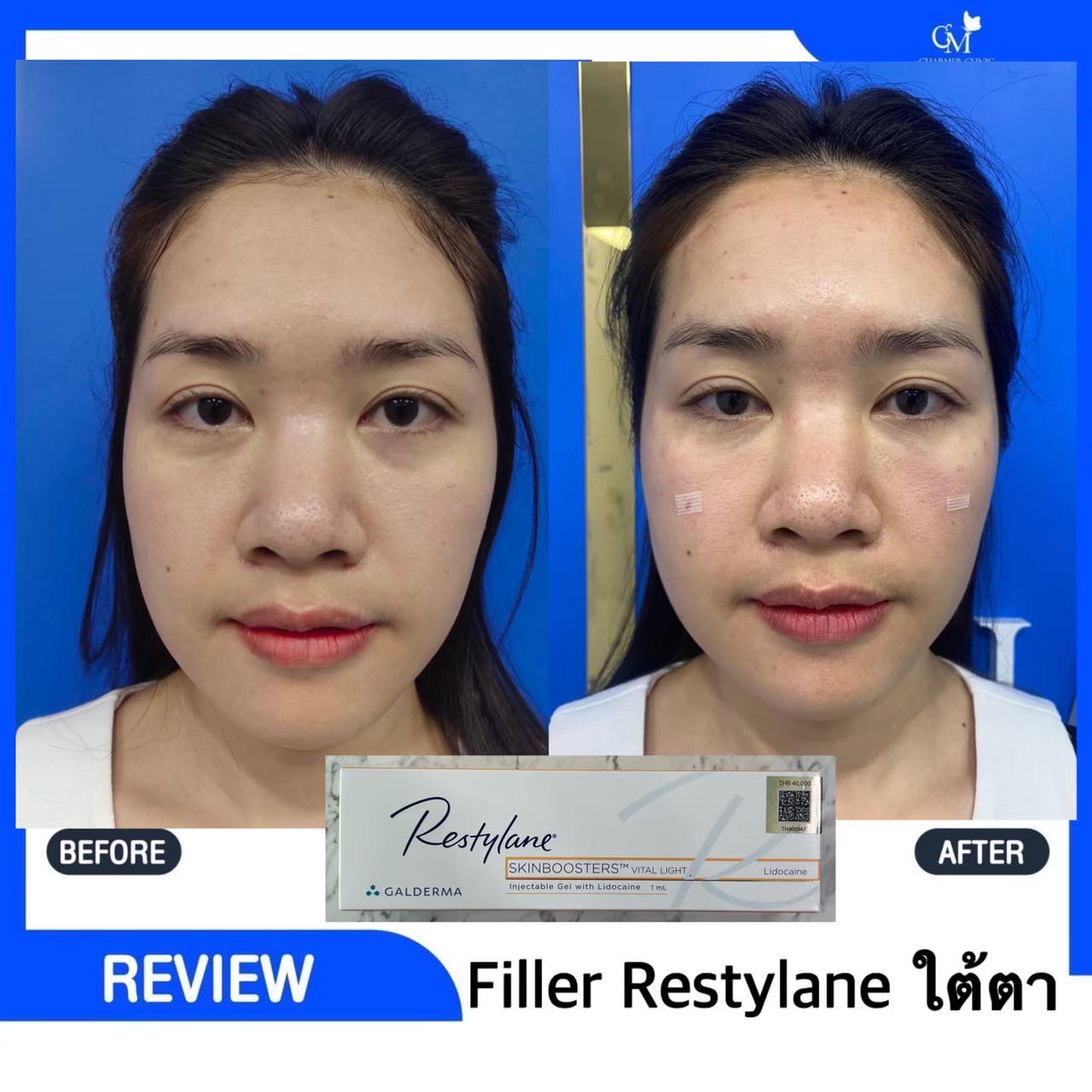 ฉีดฟิลเลอร์ Restylane Filler เติมเต็มปัญหาใต้ตา ร่องใต้ตาลึก